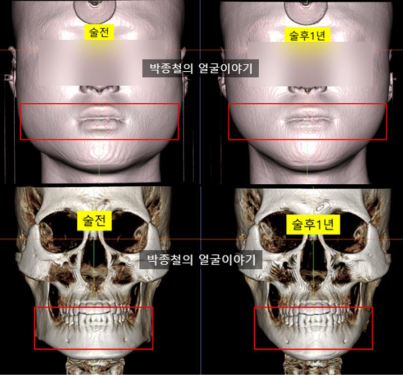 1 Year Post-Op CT Analysis of Square Jaw and Chin Surgery with Masseter ...