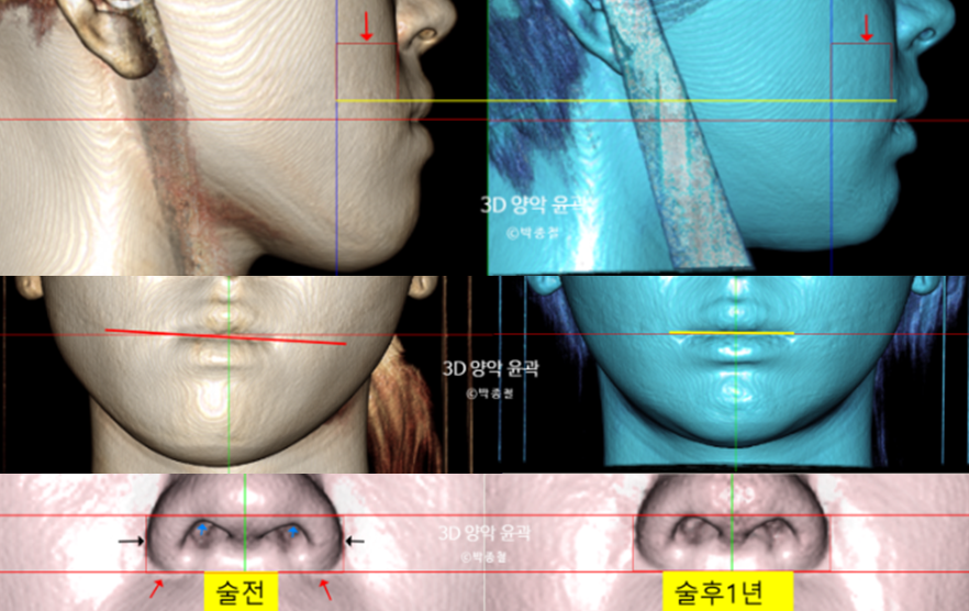 3D CT Analysis of Soft Tissue Changes After Orthognathic Surgery for ...