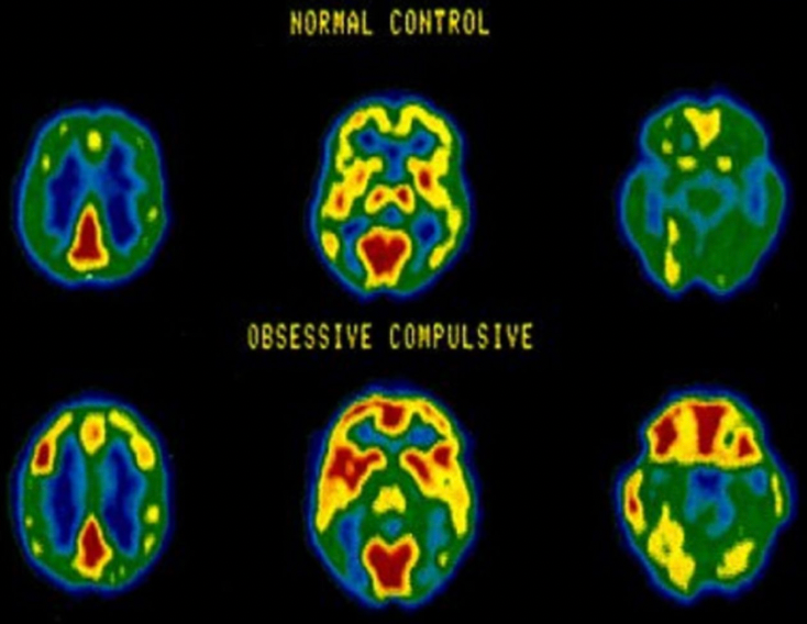 Understanding OCD: Brain Differences