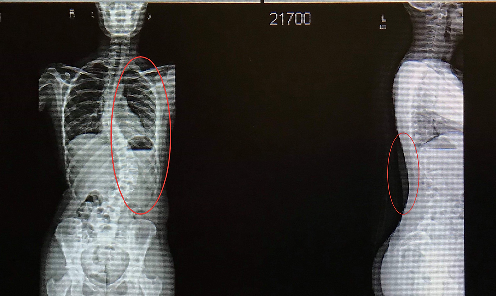 Everything You Need to Know About Rib Humps