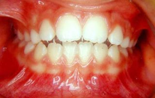 MORDIDA ABERTA ANTERIOR | Clínica Dr. Aidar