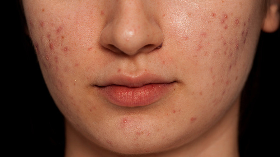 Acne Prone Skin