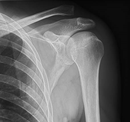 Rayos X Clavícula (2 proyecciones) | UniRad