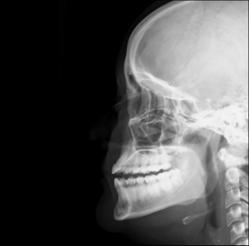 Rayos X de ATM Mandíbula (1 proyección) | UniRad