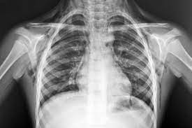 Rayos X Tórax Óseo (1 proyección) | UniRad