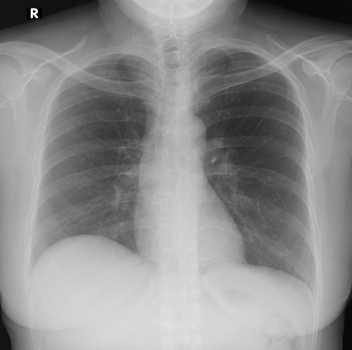 Rayos X Tele de Tórax (Radiografía - 1 proyección) Mérida, Yucatán ...