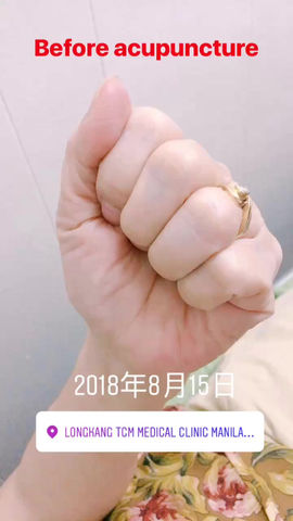 Acupuncture and Traditional Chinese Medicine for trigger finger/ finger ...