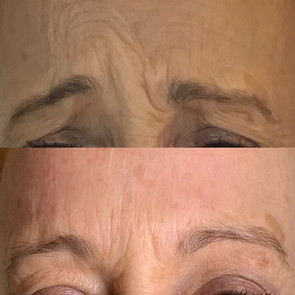 Botox and Dysport Before and After | Rejuv.