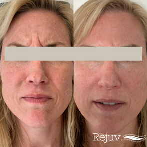 Botox and Dysport Before and After | Rejuv.