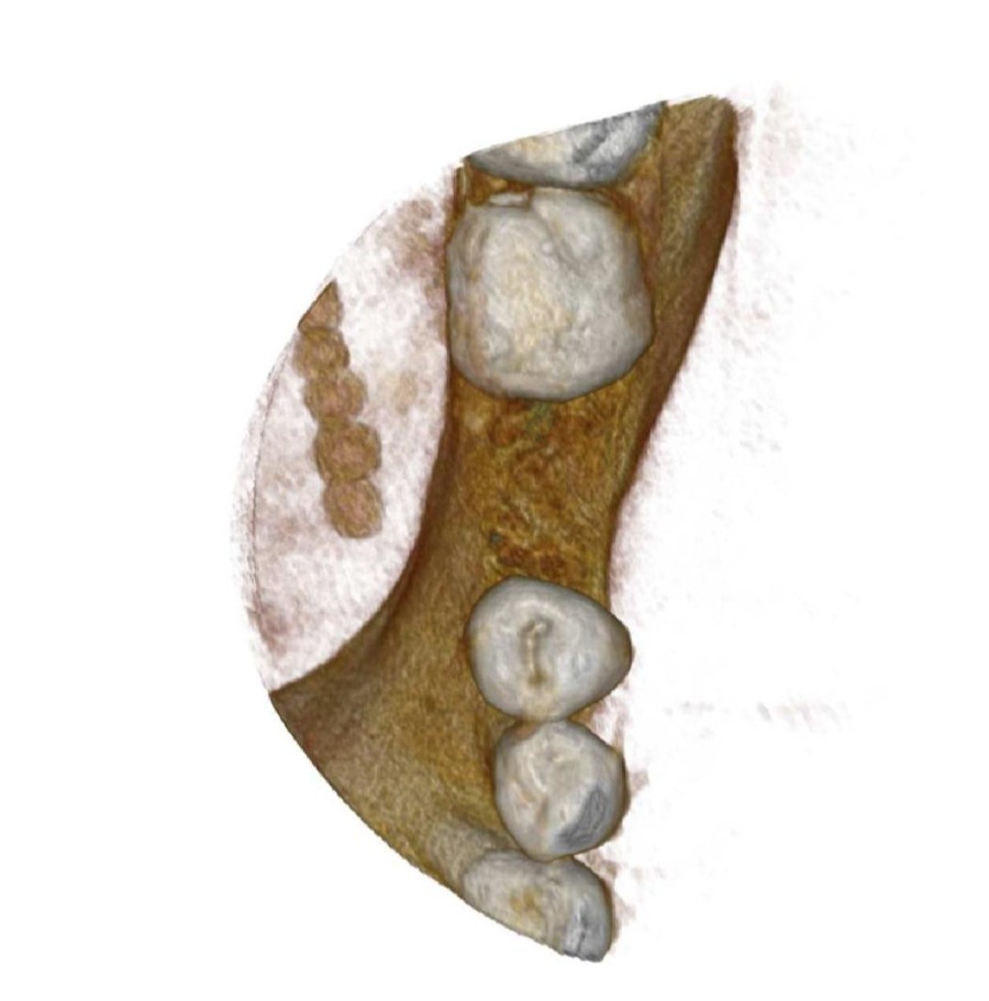 Sialolithiasis (Salivary gland stone) - Salivary gland calculus