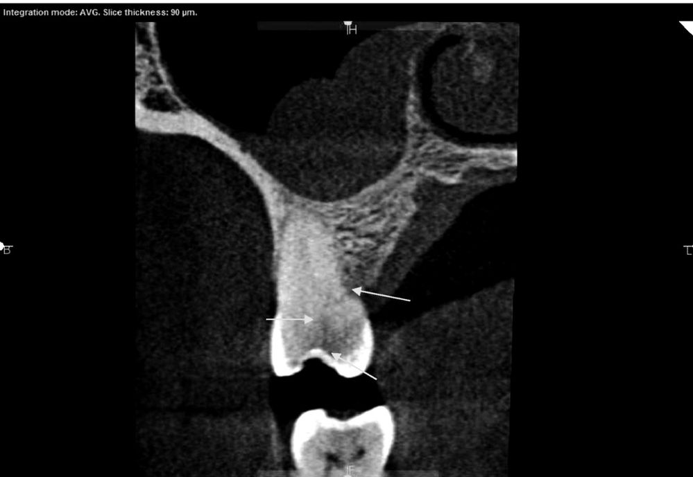 Cracked tooth diagnosis - Root fracture in CBCT