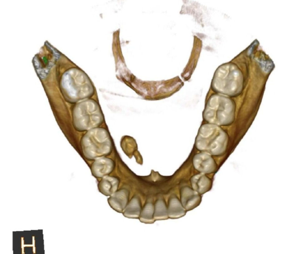 Sialolithiasis (Salivary gland stone) - Salivary gland calculus