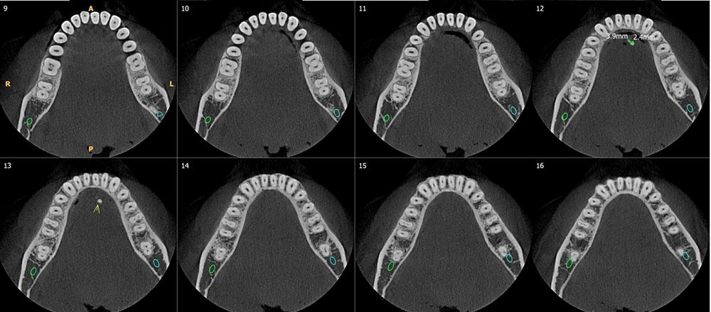 Sialolithiasis (Salivary gland stone) - Salivary gland calculus
