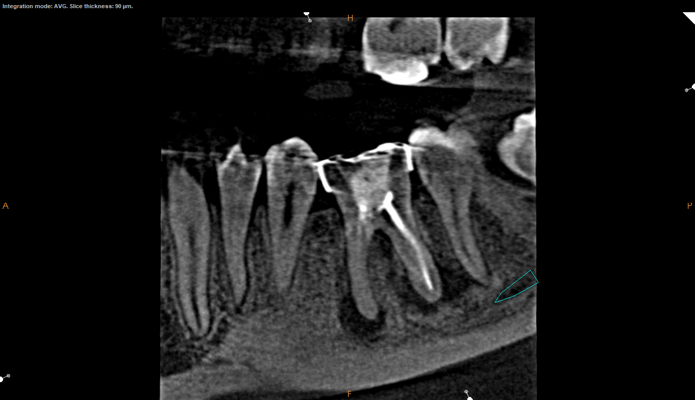 Cracked tooth diagnosis - Root fracture in CBCT