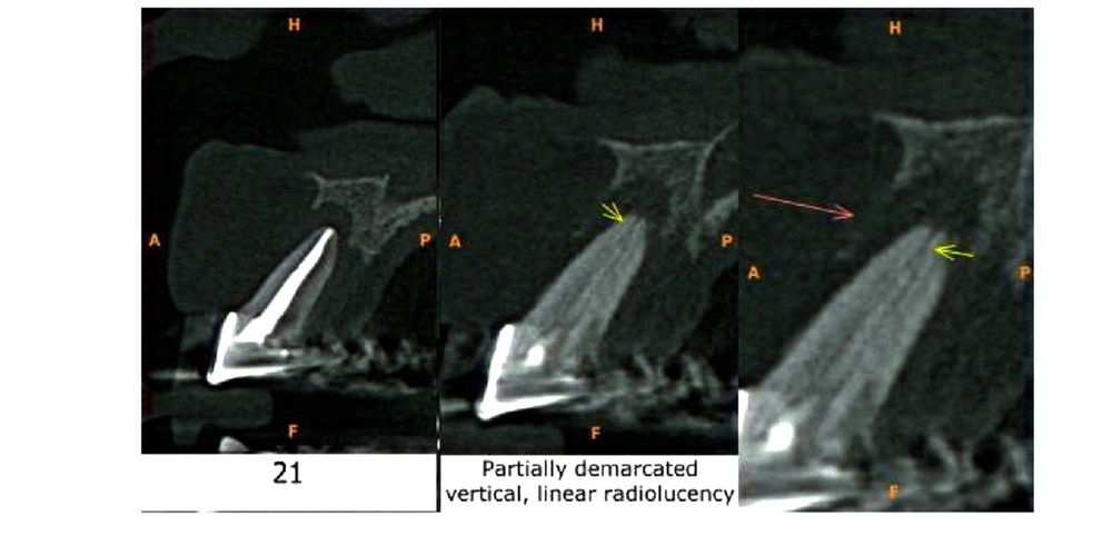Cracked tooth diagnosis - Root fracture in CBCT