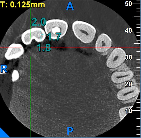 FOV (Field of visualization) and its relation to treatment requirements ...