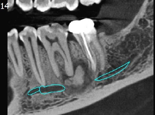 Lamina dura in CBCT