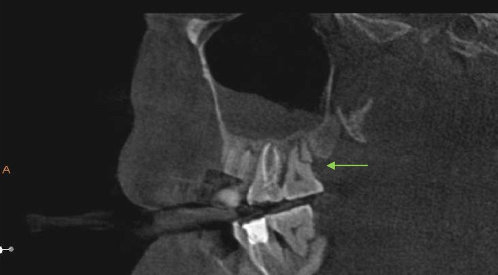 Cracked tooth diagnosis - Root fracture in CBCT