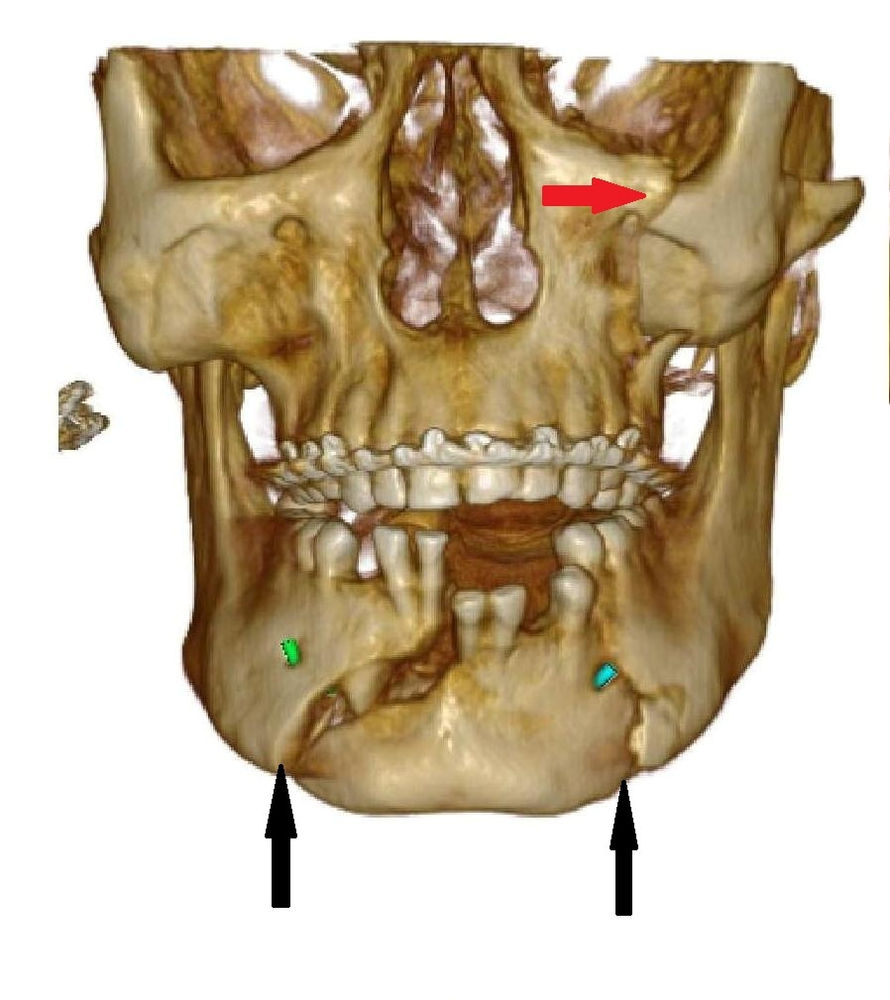 Maxillofacial trauma imaging using CBCT