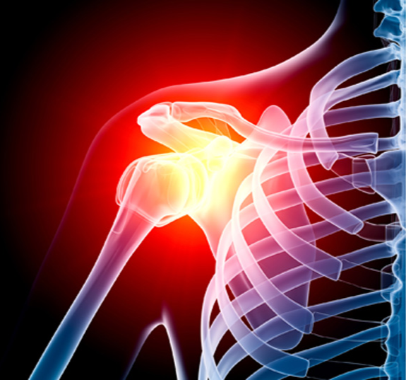 Demystifying Bursitis: Dispelling Common Misconceptions and ... Demystifying Bursitis: Dispelling Common Misconceptions and ...