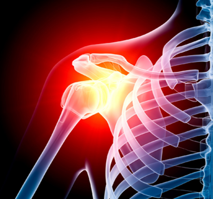 Understanding Bursitis: Causes, Symptoms & Relief Options