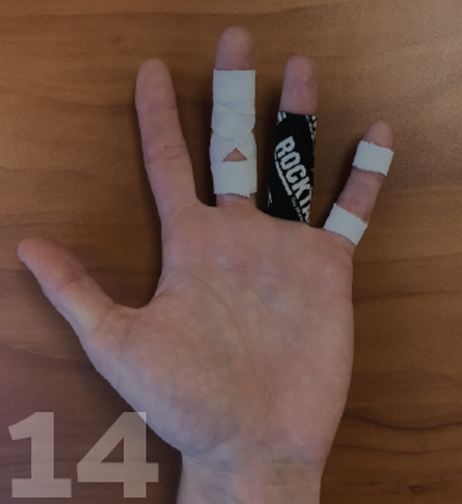 Climbing Finger Injuries: What Now?