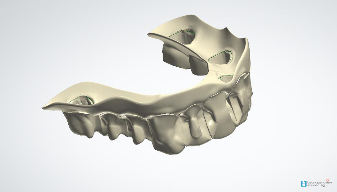 Hybridprothese | Baumgartner + Studer