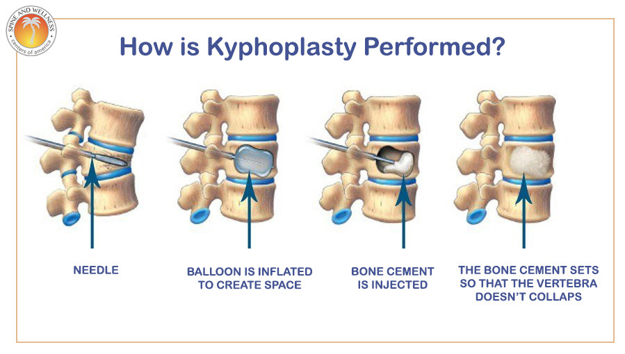 Kyphoplasty for Spine Fractures | SWCA Pain Management