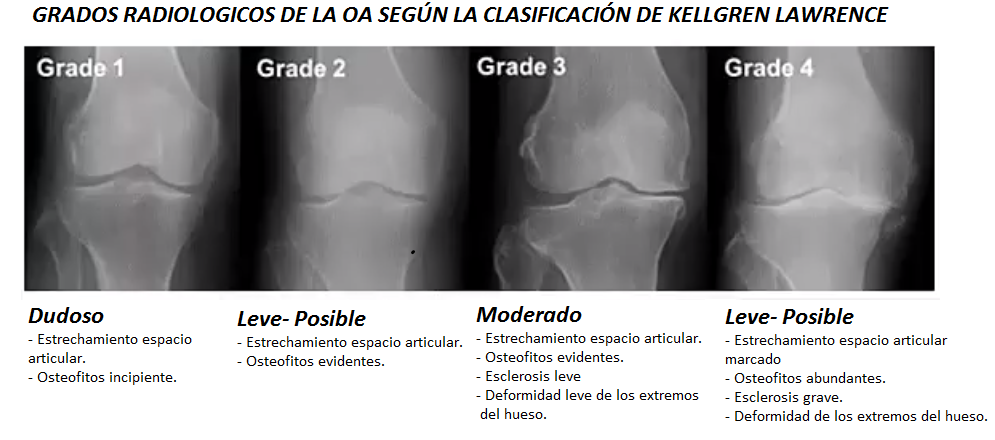 ACIDO HIALURONICO O PLASMA RICO EN PLAQUETAS.