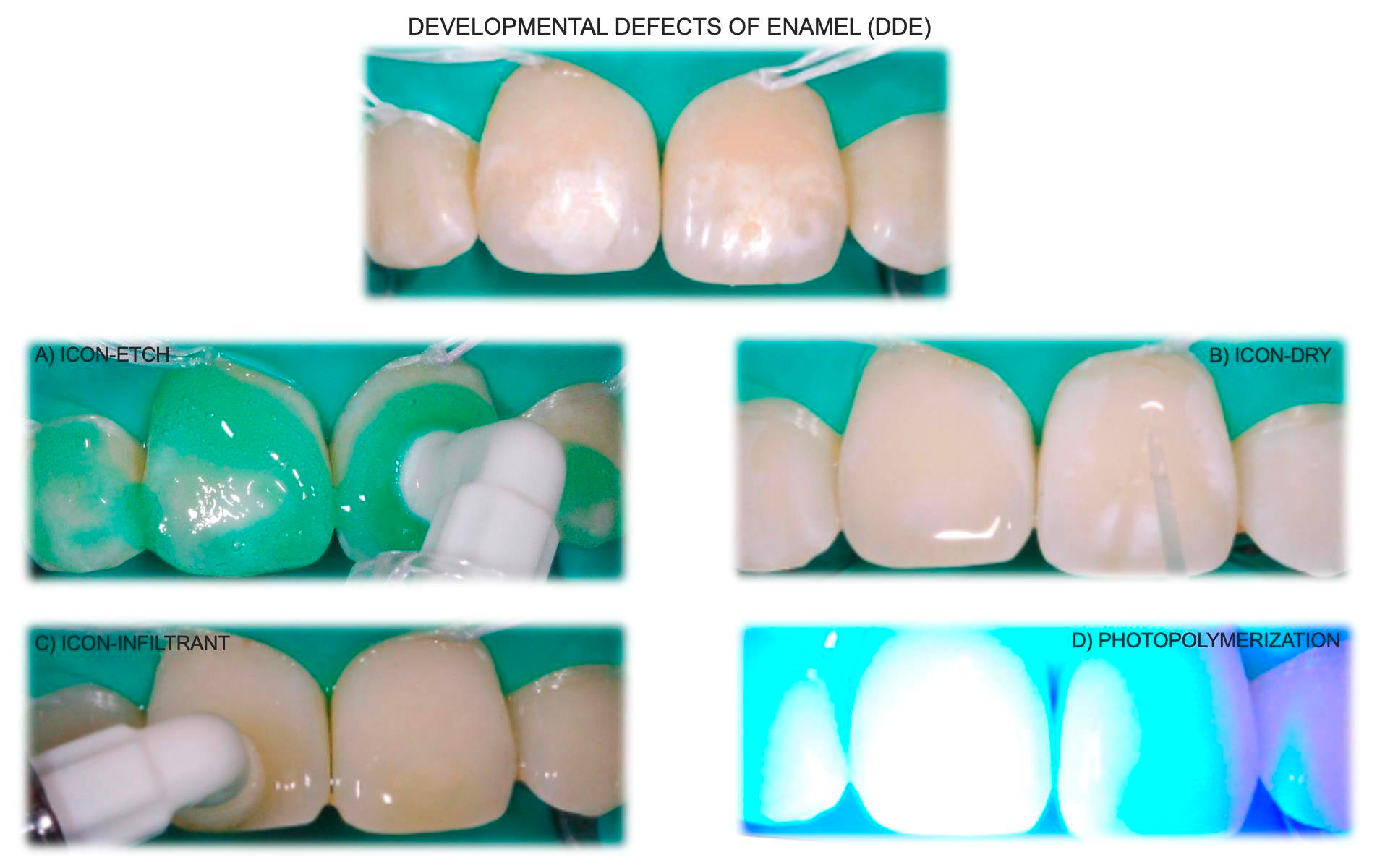 Icon Resin Infiltration Lok Dental Clinic