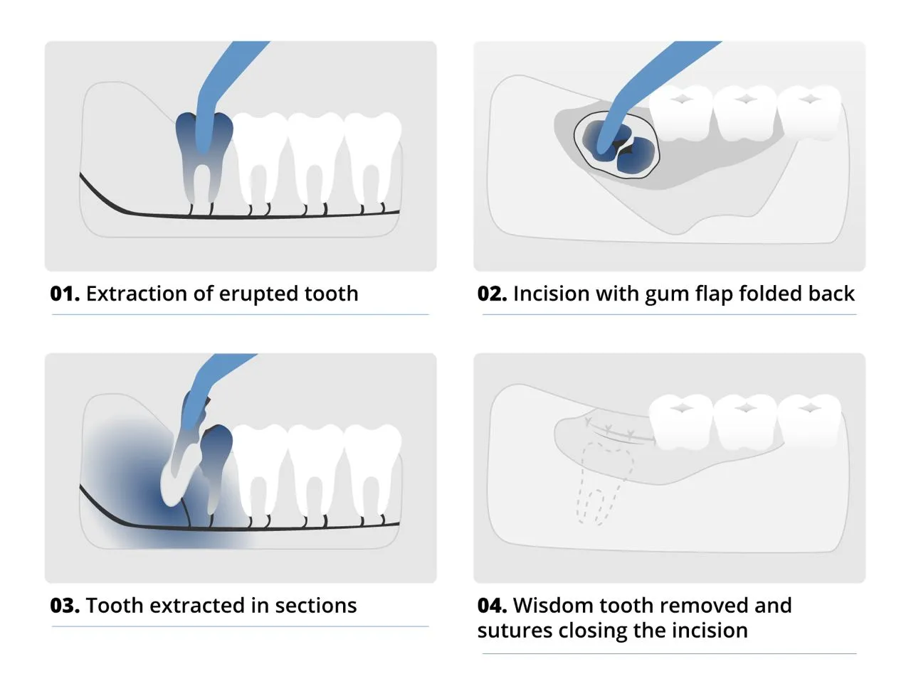 Wisdom Teeth Removal | Lok Dental Clinic