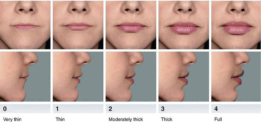 Lip Injections Gold Coast | Lip Filler Southport | Simetics Beauty