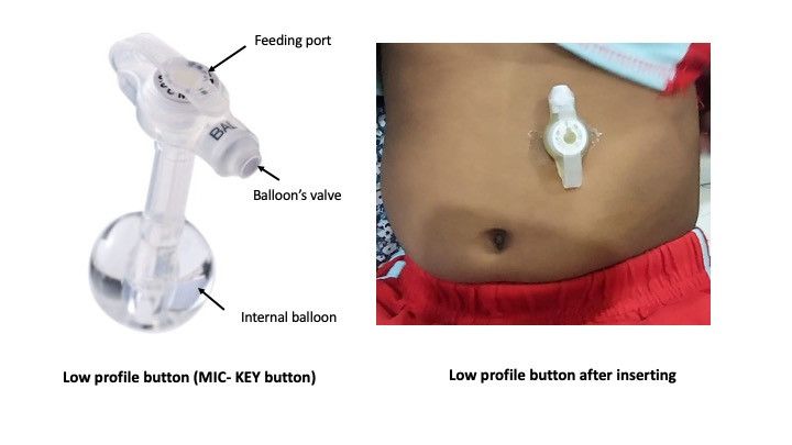 Gastrostomy Button