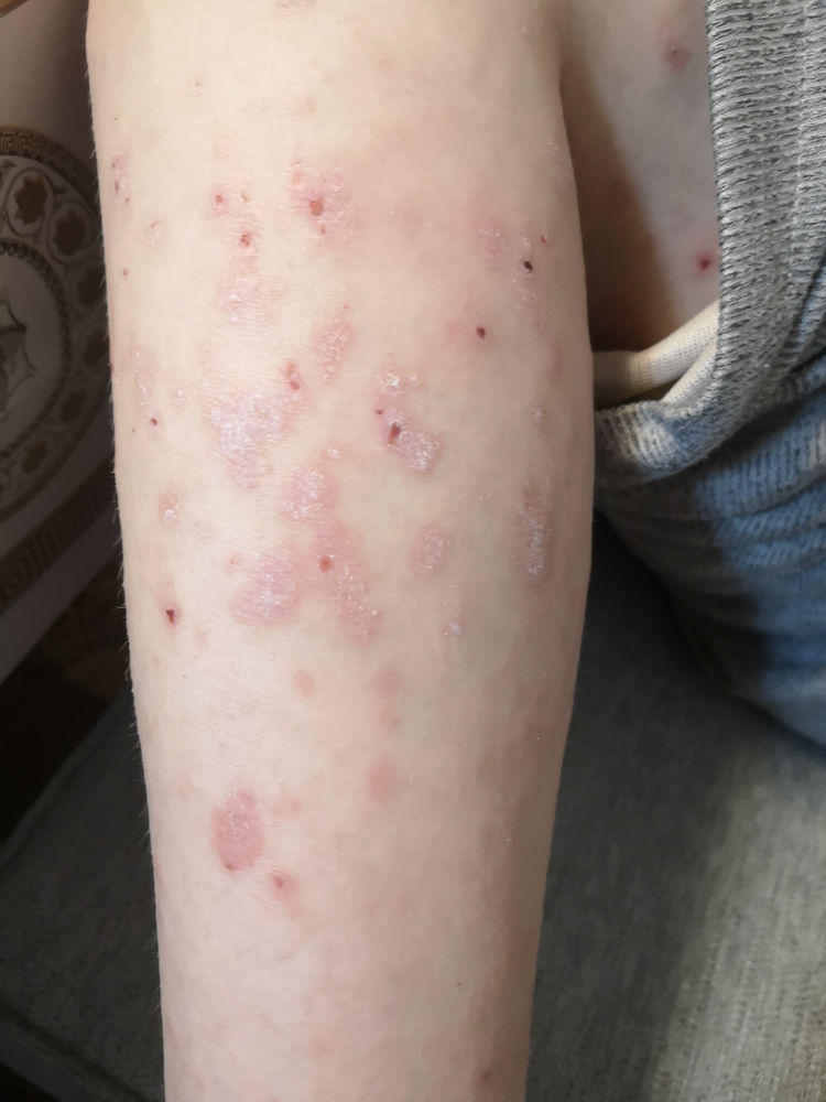 Ausschlag und starker Juckreiz | Hautarzt Digital