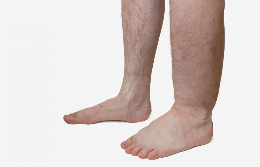 Causes of Leg & Ankle Swelling