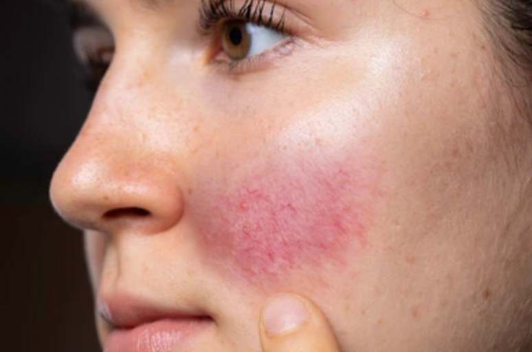 The Different Types of Rosacea Explained: What Are They and How Do They ...