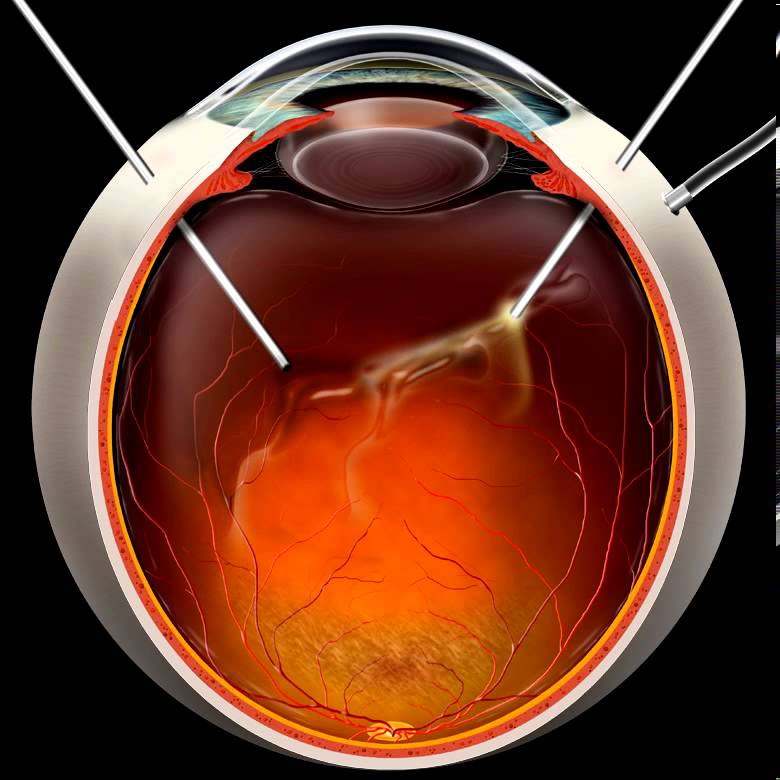 lésion oculaire – Réalités Biomédicales