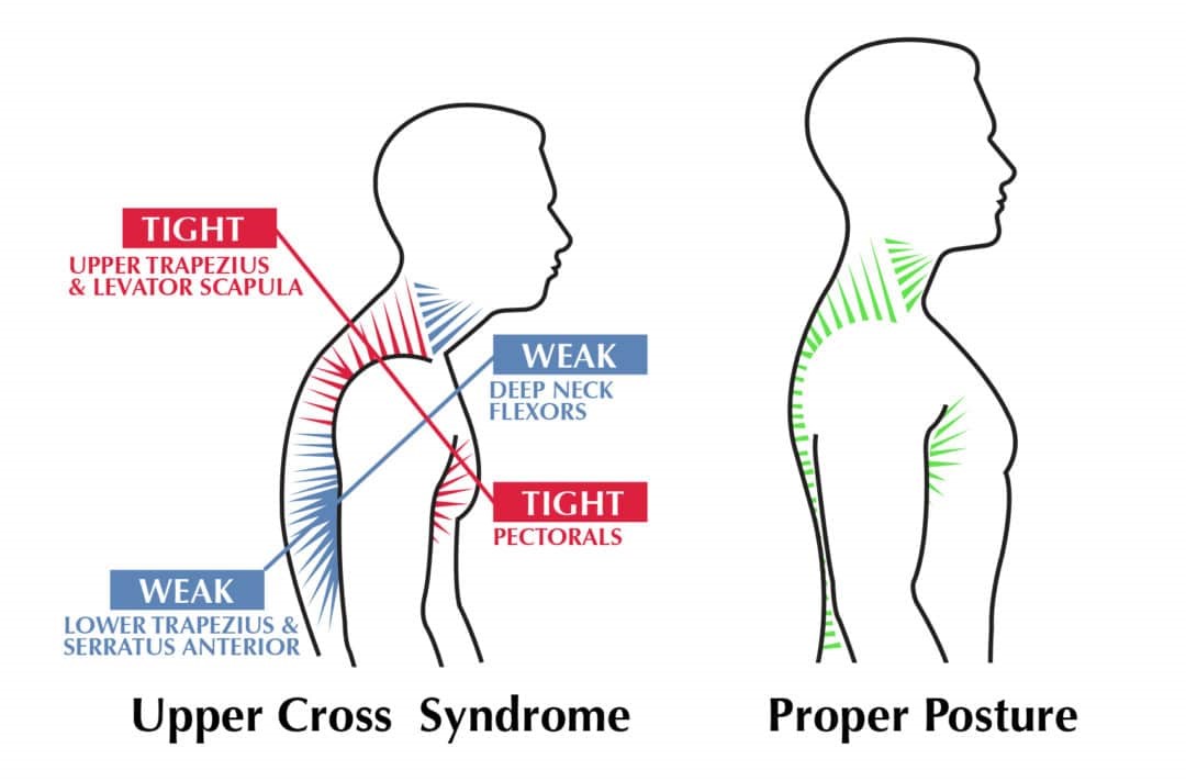 How To Fix Upper Crossed Syndrome