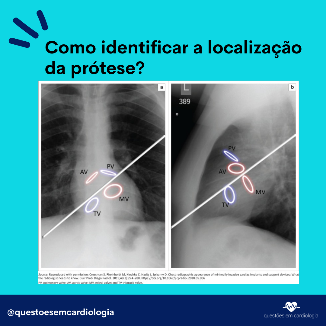 How to identify prosthetic valves on chest X-ray?