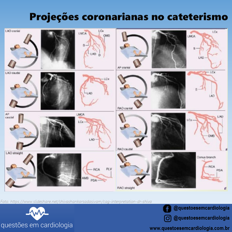 Quais as principais projeções durante exame de cateterismo cardíaco e ...