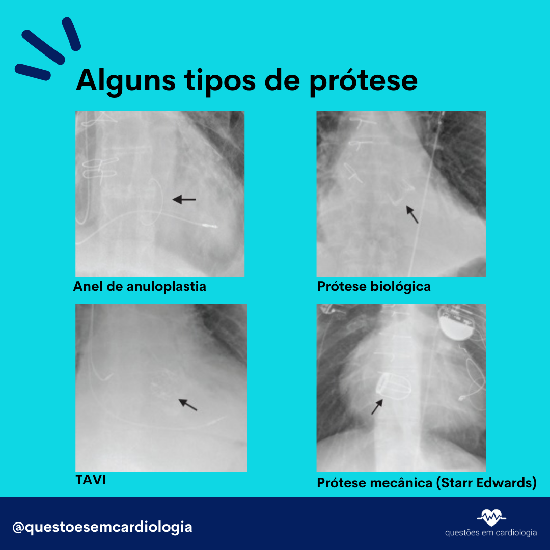 How to identify prosthetic valves on chest X-ray?