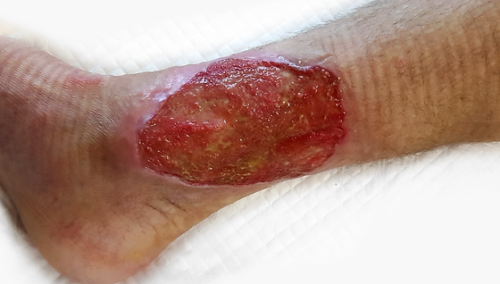 wounds ulcers