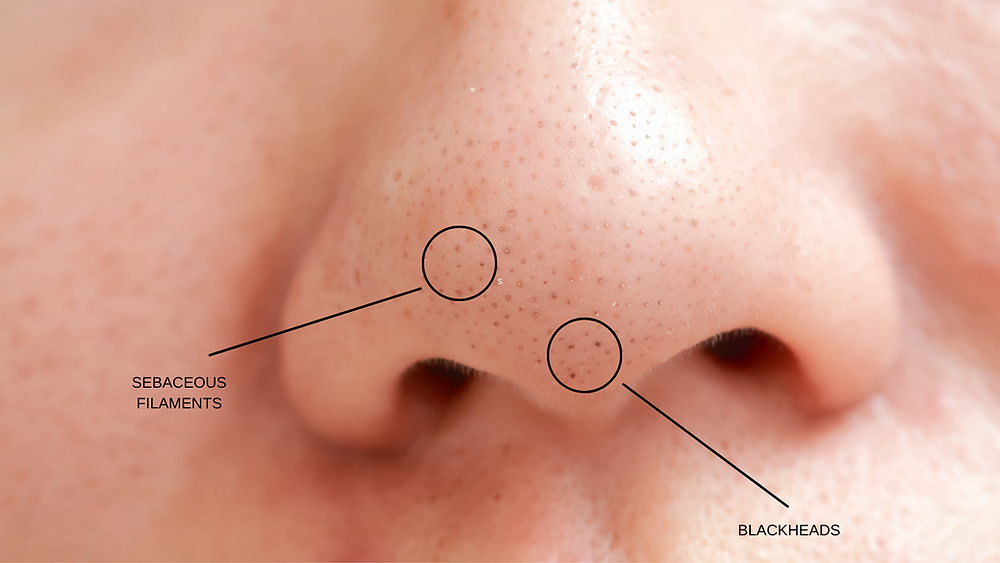 Black Heads or Sebaceous Filaments
