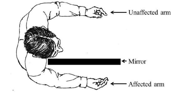 Épaule gelée : mieux comprendre la capsulite rétractile