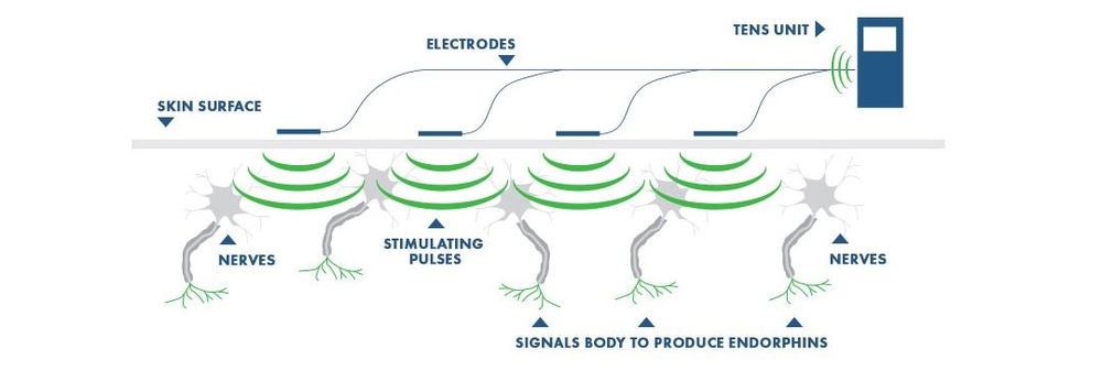 Know everything about TENS (Transcutaneous Electrical Nerve Stimulation)