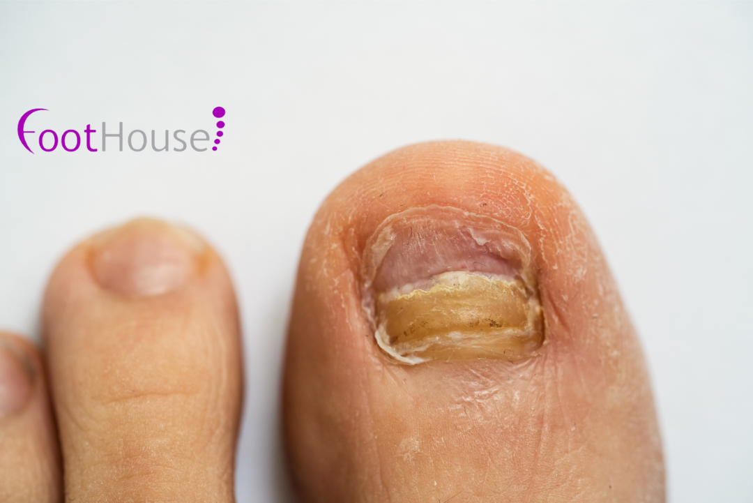 Fungal Toe Nail | FootHouse Podiatry and Biomechanics | Folkestone