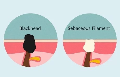Sebaceous Filaments: They're Not What You Think