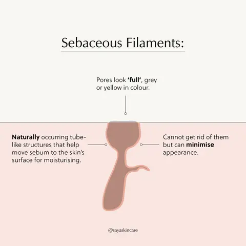 Sebaceous Filaments: They're Not What You Think