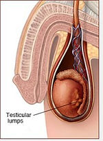 testicle lump