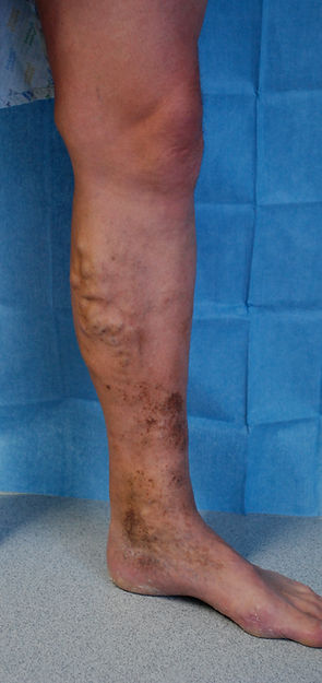 Recurrent Varicose Veins